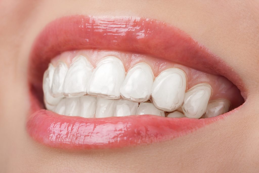 Understanding the Braces Mechanism | Brighton Dental Labs